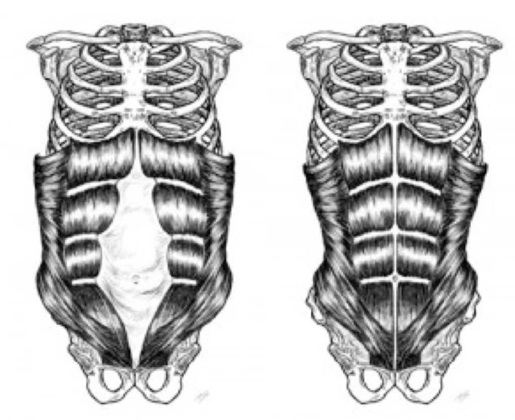 What is a Diastasis? – Strong Tummies